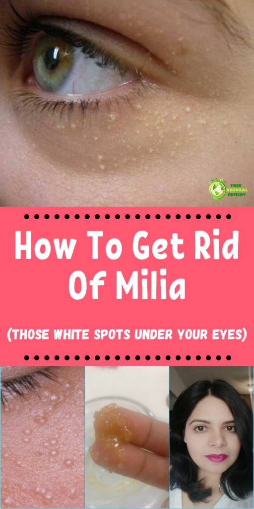 Milia: How To Remove The Small White Skin Cysts? – 1mdolars